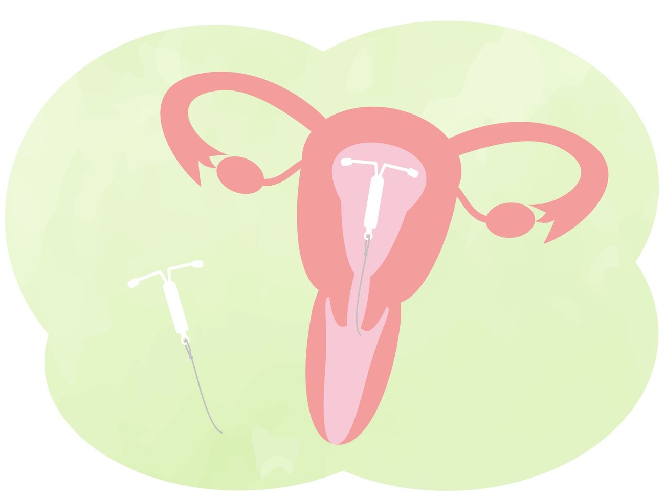 Hormonspirale: Für wen ist sie geeignet?