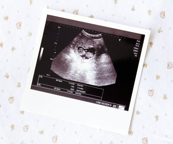 Windei oder Blasenmole: Schwangerschaft ohne Embryo