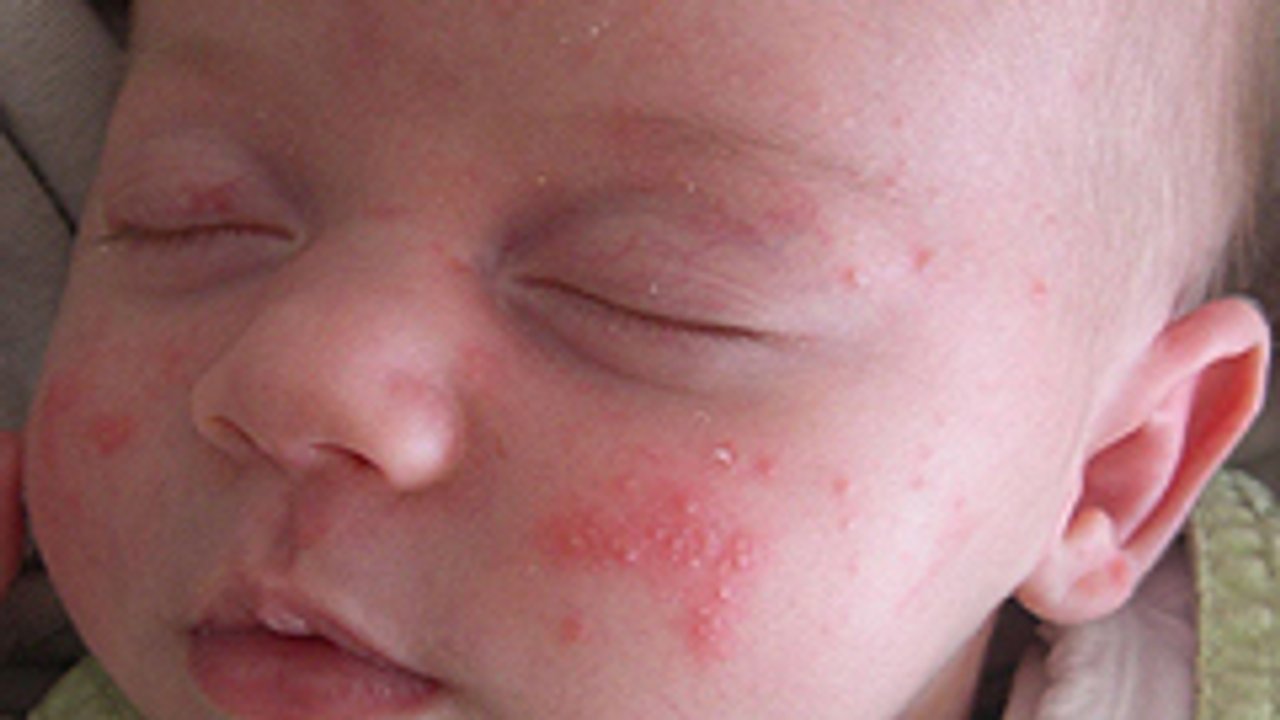 Neugeborenenakne: Was tun bei Babyakne?