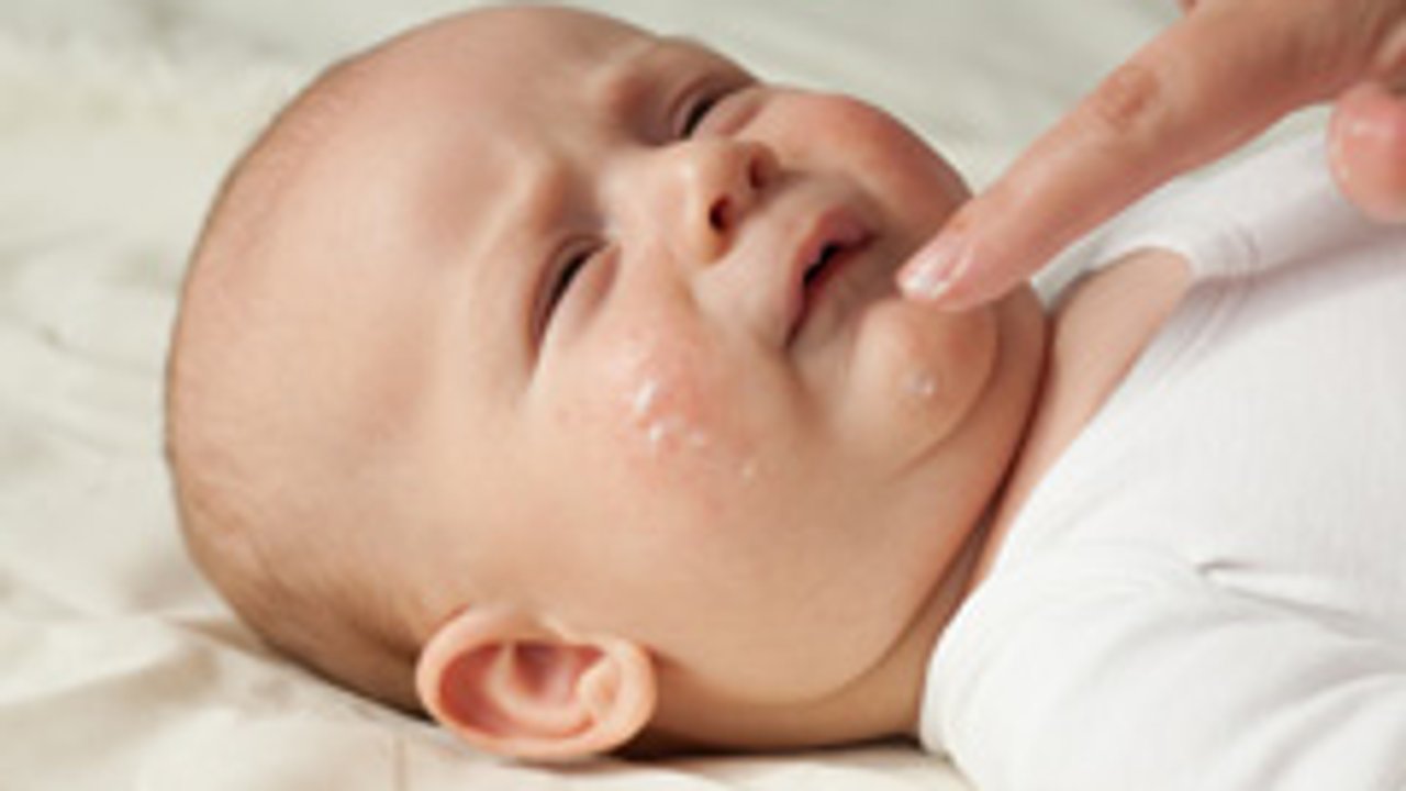 Neurodermitis: Wenn Babys Haut juckt