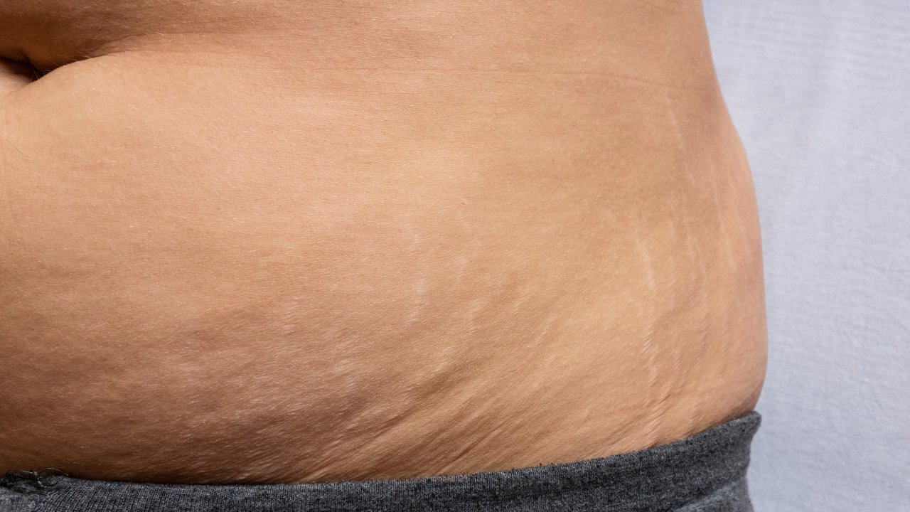 Der Bauch nach Geburt: Fakten, Tipps & ehrliche Fotos